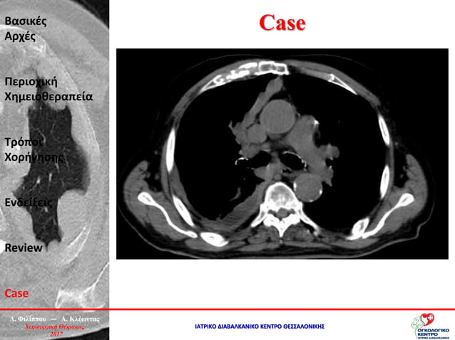 HITHOC - Hyperthermic Intrathoracic Chemotherapy - Ενδοθωρακική ...