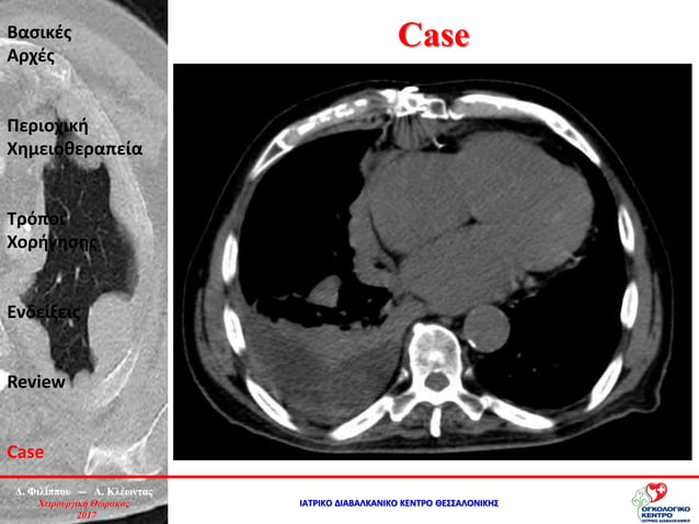 HITHOC - Hyperthermic Intrathoracic Chemotherapy - Ενδοθωρακική ...