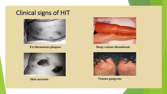 Heparin Thrombocytopenia Presentationppt | PPT