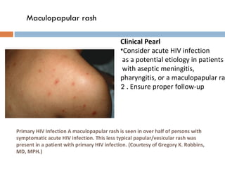 Maculopapular Rash Hiv