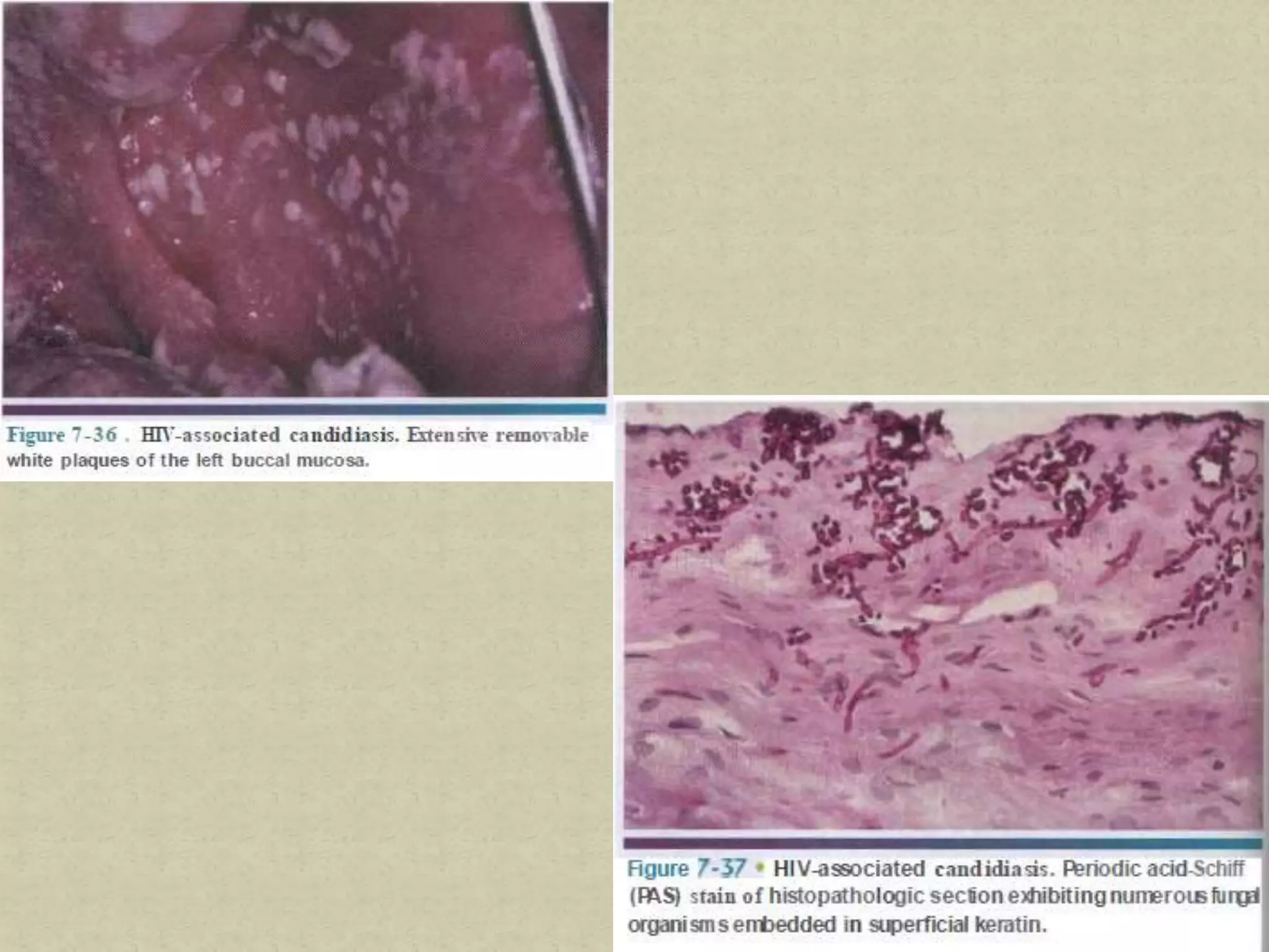 oral manifestations of HIV.pptx