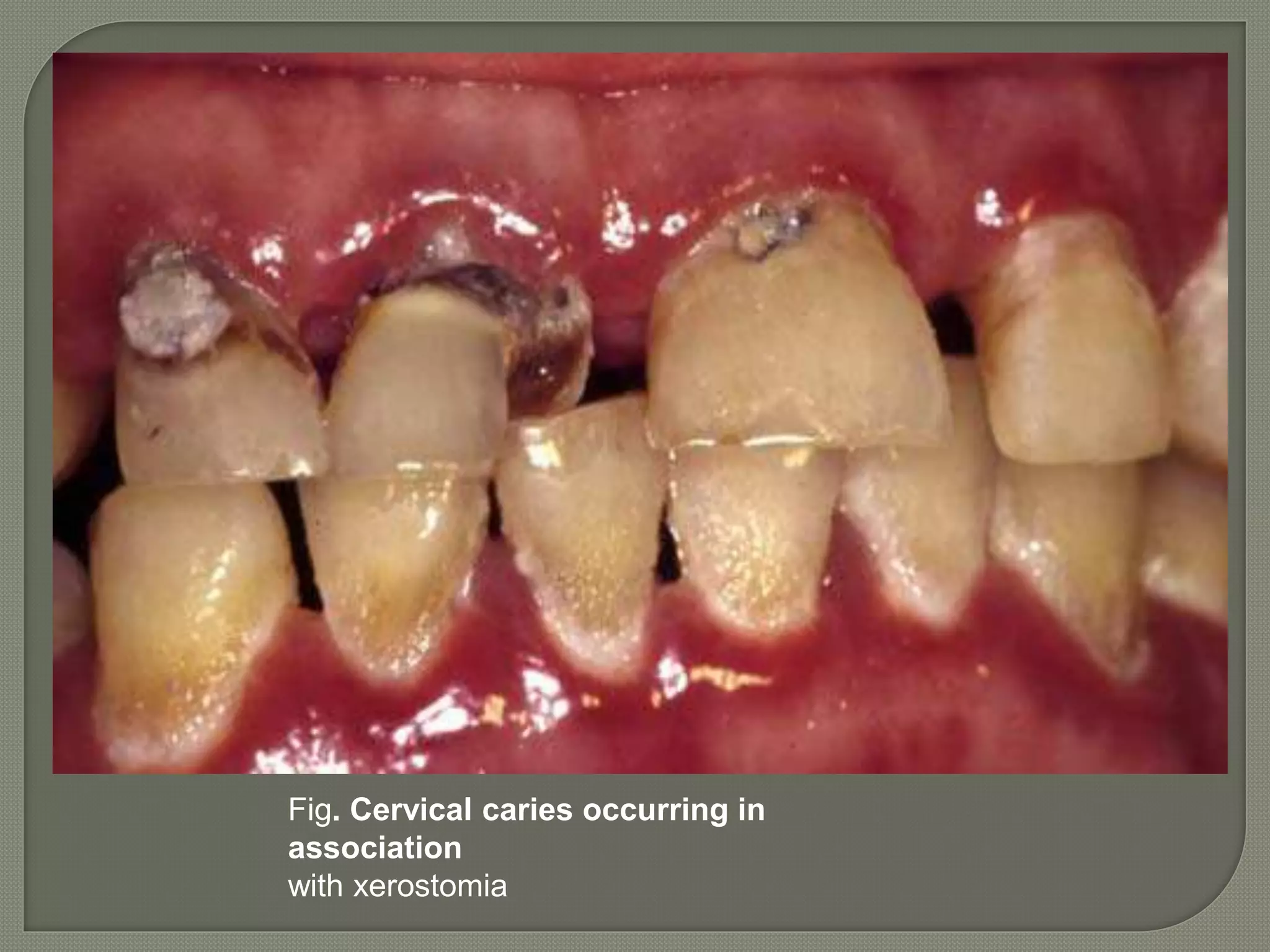 ORAL MENIFESTATION OF HIV AIDS | PPTX