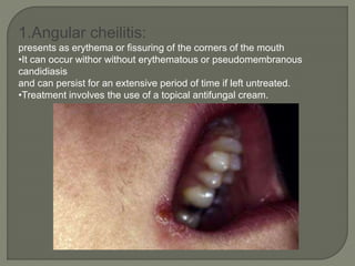 Angular Cheilitis Hiv