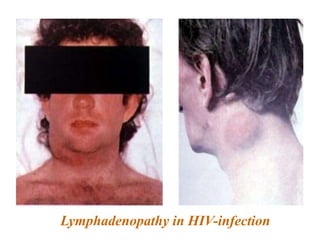 HIV infection. HIV-associated related opportunistic infections and ...