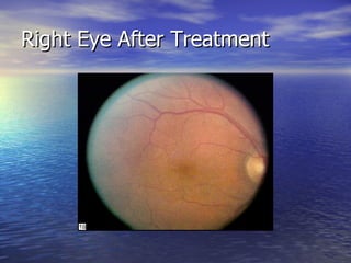 Hiv Retinopathy Oct