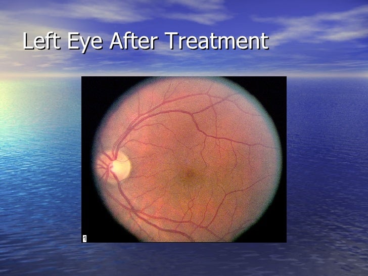 HIV Retinopathy