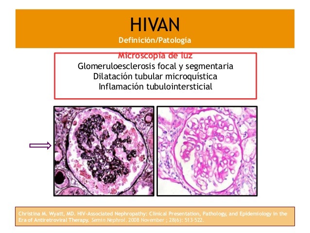 HIVAN (Nefropatía asociada al VIH) Evidencia al 2015