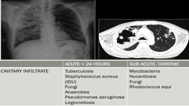 HIV AND LUNGSpulmonary infections in hiv paients | PPT