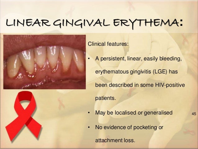 Linear Gingival Erythema Journal Of Syiah Kuala Dentistry Society