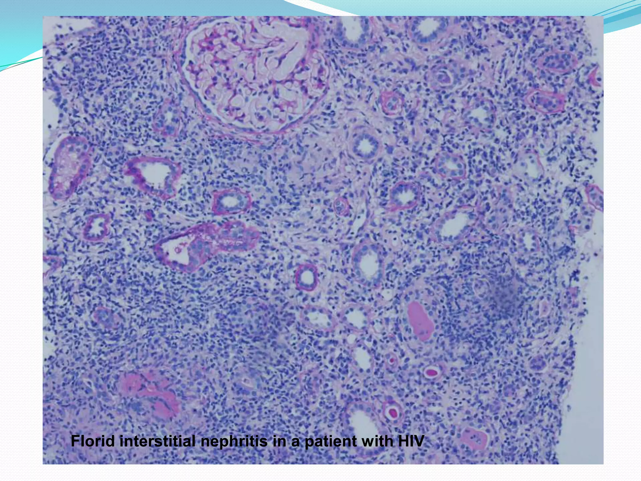 Hiv associated nephropathy(Dr. sood) | PPTX