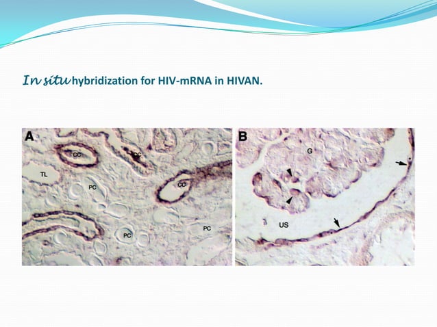 Hiv associated nephropathy(Dr. sood) | PPTX | Blood Disorders ...
