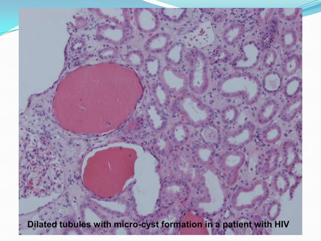 Hiv associated nephropathy(Dr. sood) | PPTX | Blood Disorders ...