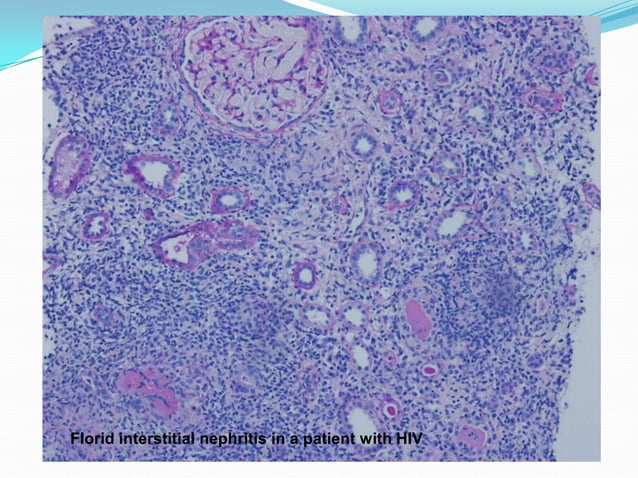 Hiv associated nephropathy(Dr. sood) | PPTX | Blood Disorders ...