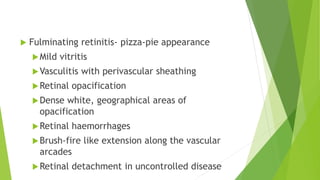 HIV associated ocular disease.pptx