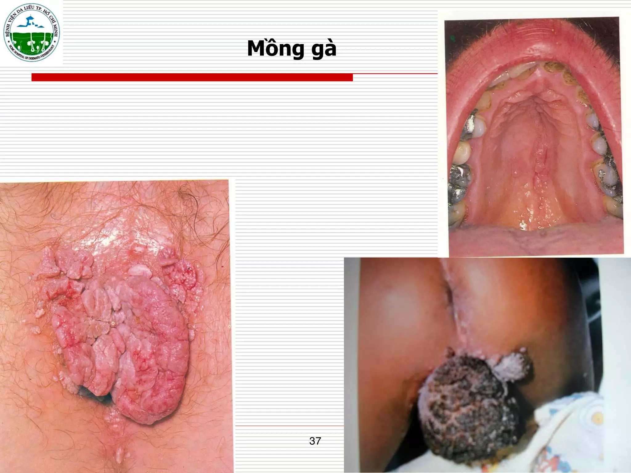 HỘI CHỨNG SUY GIẢM MIỄN DỊCH MẮC PHẢI (AIDS) VÀ CÁC BIỂU HIỆN NGOÀI DA | PDF