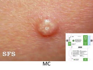 Acquired Immunodeficiency Syndrome; what can skin tell? | PPTX