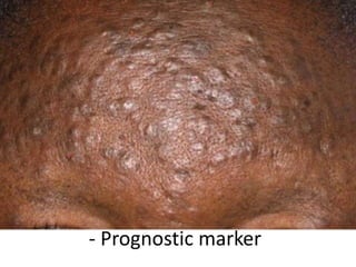 Acquired Immunodeficiency Syndrome; what can skin tell? | PPTX