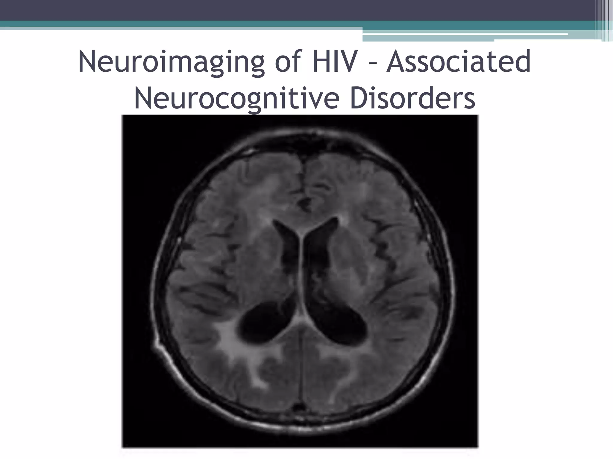 HIV Infection Encephalitis | PPTX