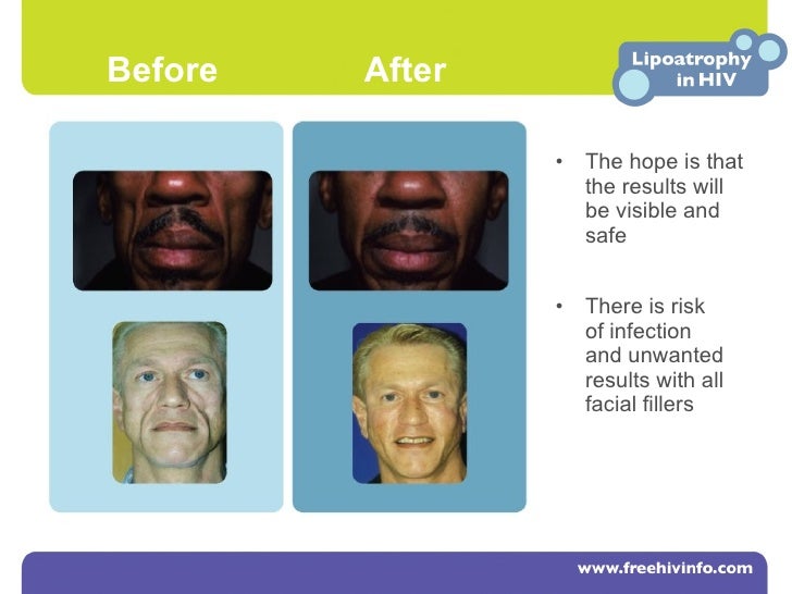 Hiv Lipoatrophy 2007