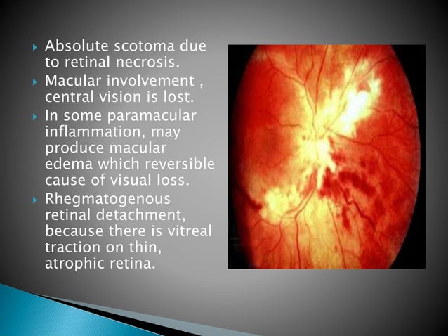 Hiv retinopathy | PPTX