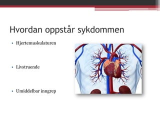 Hjerteinfarkt | PPTX
