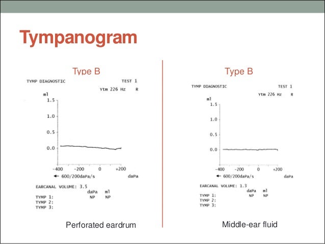 Tympanic Membrane Perforation Audiogram