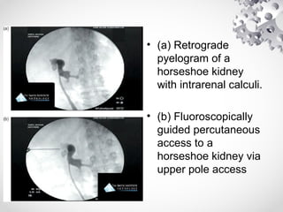 Horseshoe kidney & PCNL | PPT