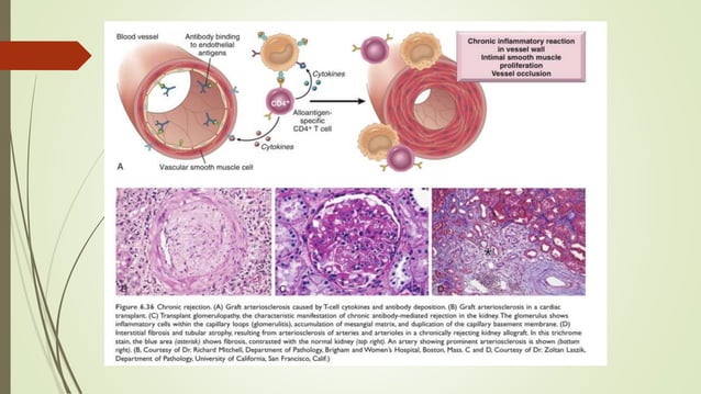 HLA Typing, Role in kidney transplant.pptx