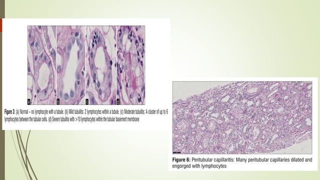 HLA Typing, Role in kidney transplant.pptx