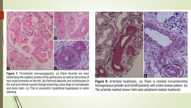 HLA Typing, Role in kidney transplant.pptx