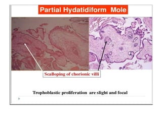HYDATIDIFORM MOLEHYDATIDIFORM MOLEHYDATIDIFORM MOLE | PPTX