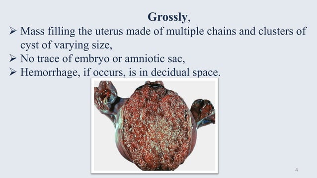 HYDATIDIFORM MOLE: APPROACH AND MANAGEMENT