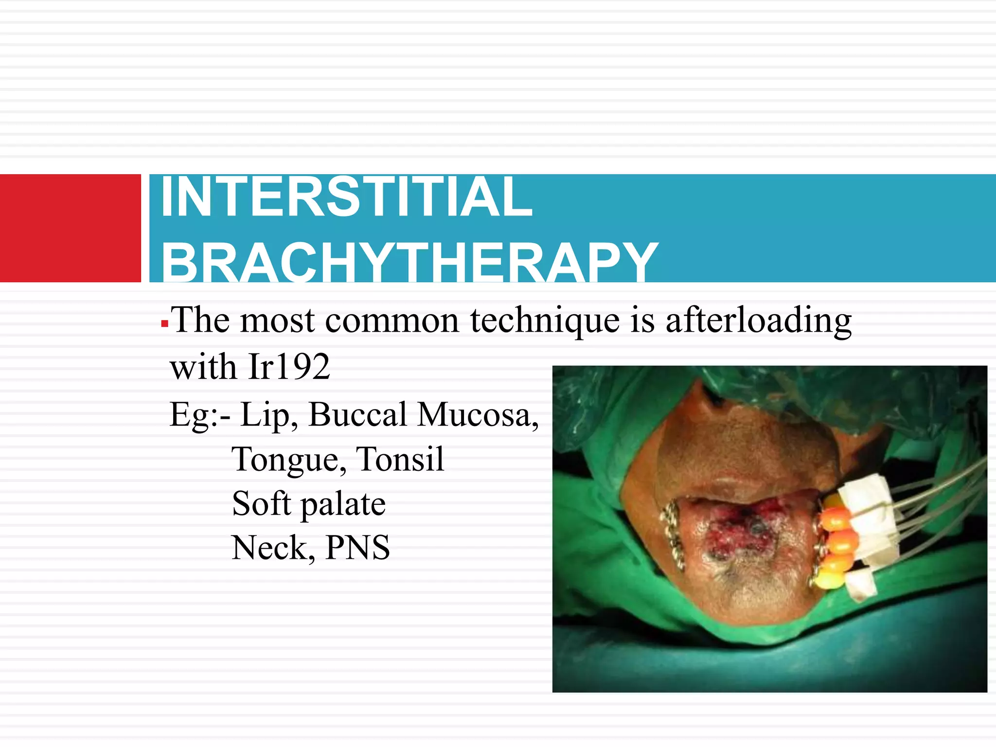 Head and neck; brachytherapy.pptx final | PPTX