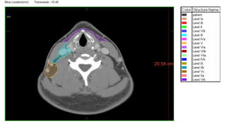 Delineation of the neck node levels for head and neck tumors: a 2013 ...