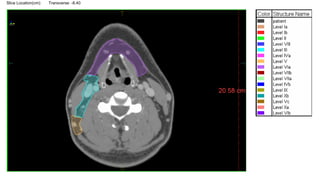 Delineation of the neck node levels for head and neck tumors: a 2013 ...