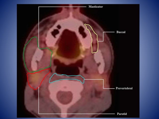 HEAD AND NECK cross sectional pet ct anatomy | PPTX | Ear, Nose and ...