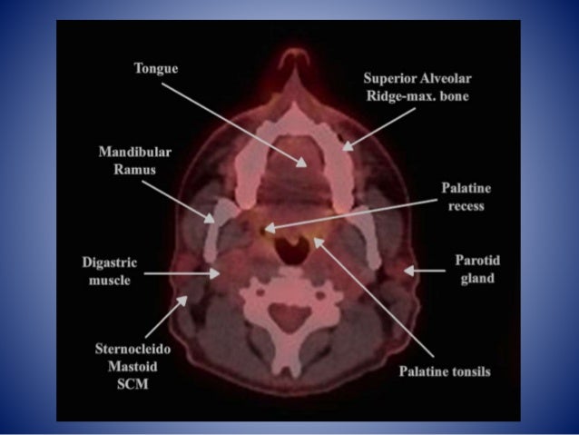 HEAD AND NECK cross sectional pet ct anatomy