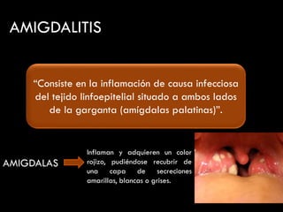 Amigdalitis | PPTX