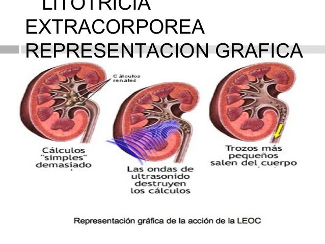 Litotricia endourologica091007 ppf