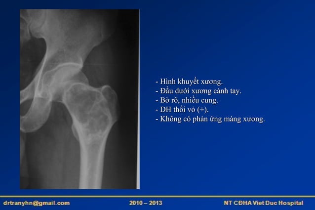 Hình ảnh xq u xương lành tính | PPT