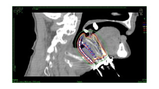 Head Neck Interstitial Brachy.pptx