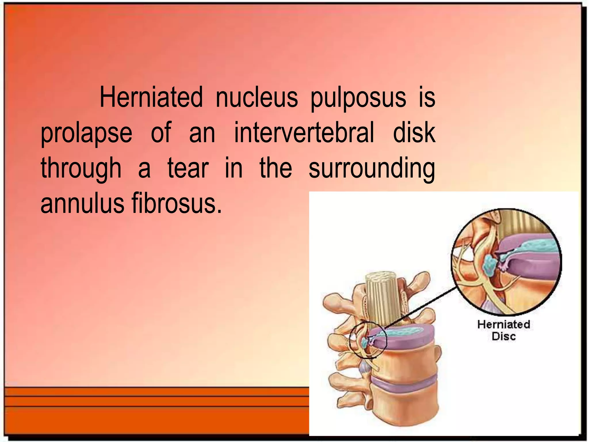 Herniated Nucleus Pulposus | PPTX