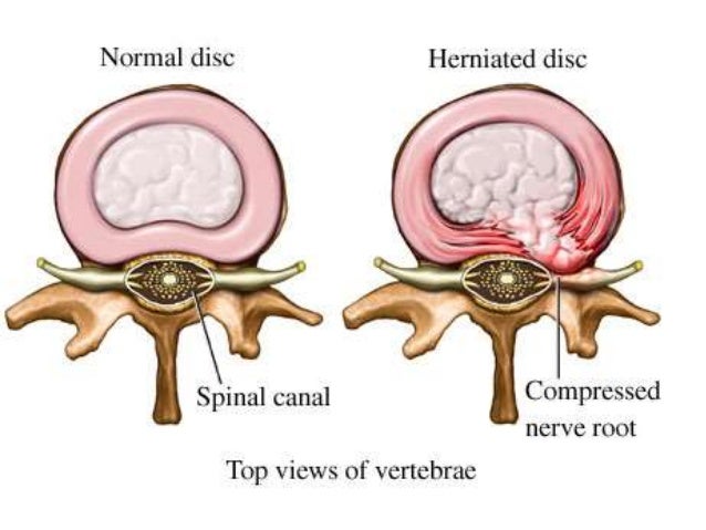 Herniated Nucleus Pulposus