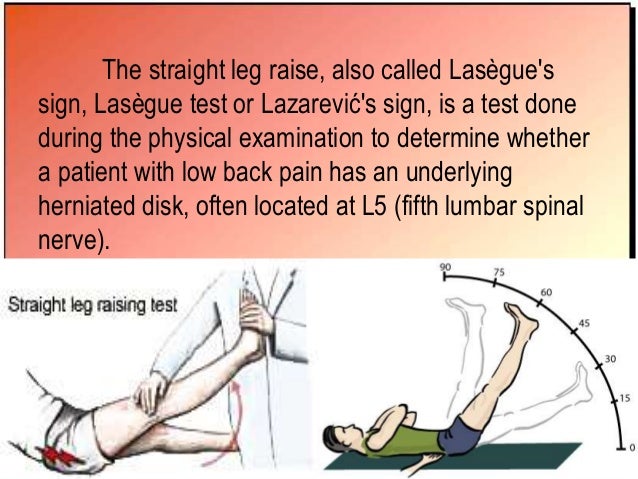 Herniated Nucleus Pulposus