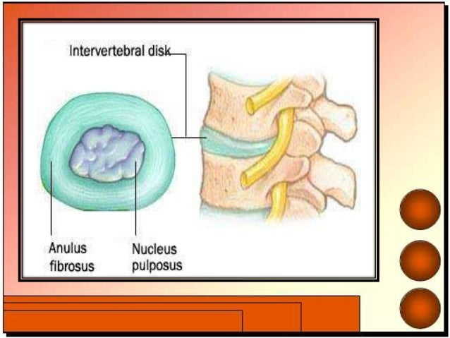 Herniated Nucleus Pulposus