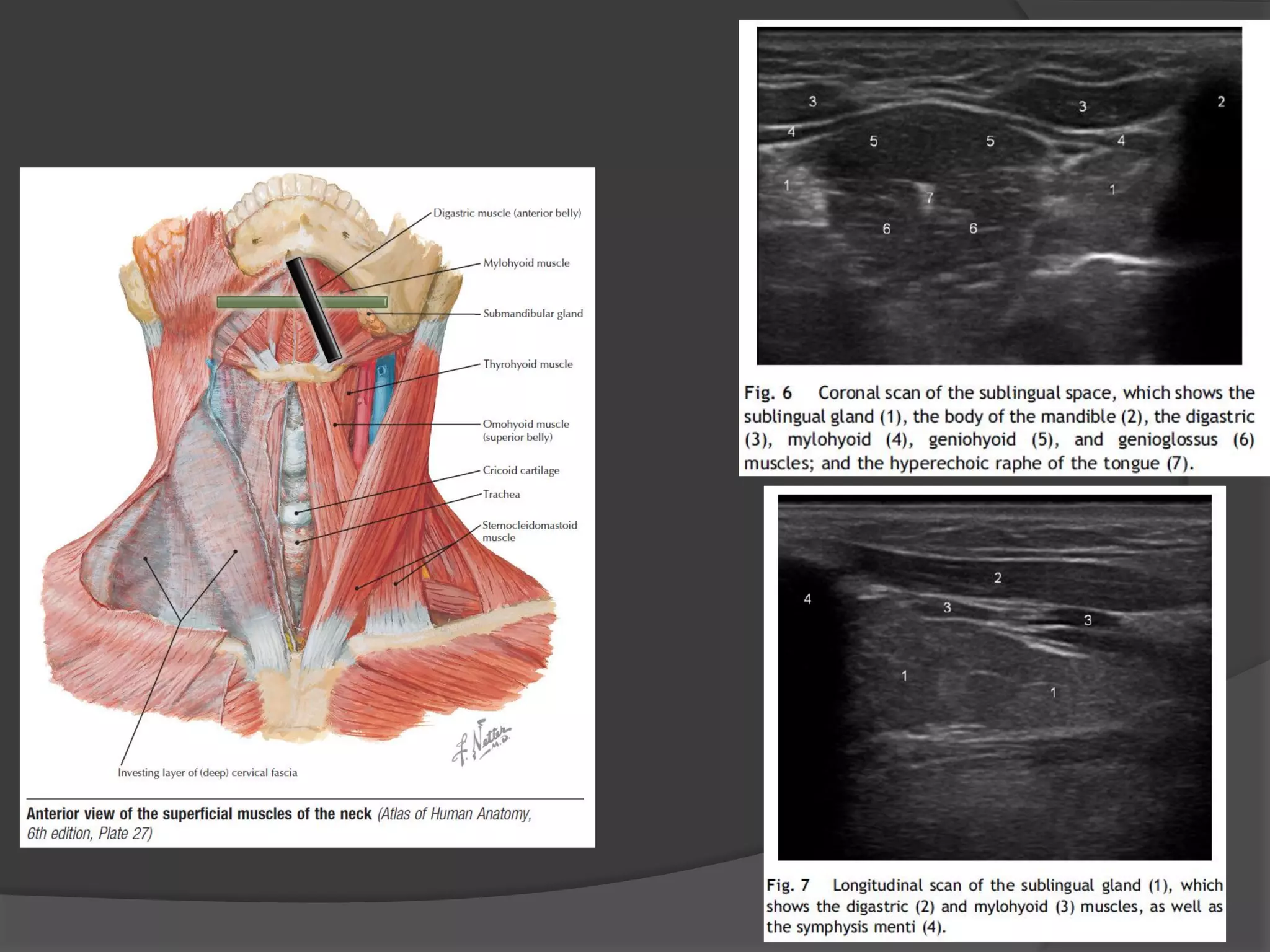 H&n sonographic anatomy of the neck and diffuse thyroid | PDF | Thyroid ...