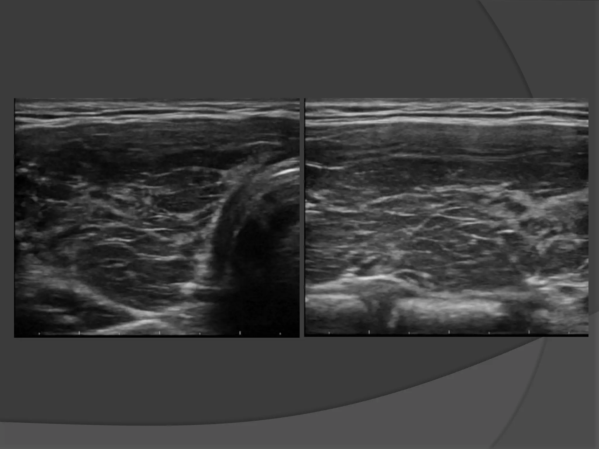 H&n sonographic anatomy of the neck and diffuse thyroid | PDF | Thyroid ...