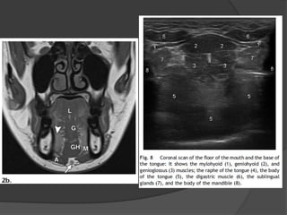 H&n sonographic anatomy of the neck and diffuse thyroid | PDF