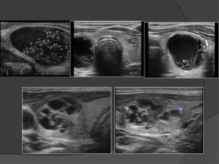 H&n sonographic anatomy of the neck and diffuse thyroid | PDF