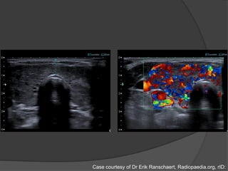 H&n sonographic anatomy of the neck and diffuse thyroid | PDF